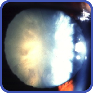 Shield Cataract Atopic Dermatitis